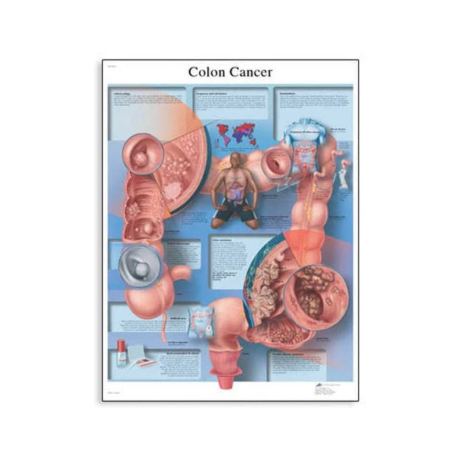 Fabrication Enterprises Inc Z12992 Colon Cancer Anatomical Chart, Paper ...