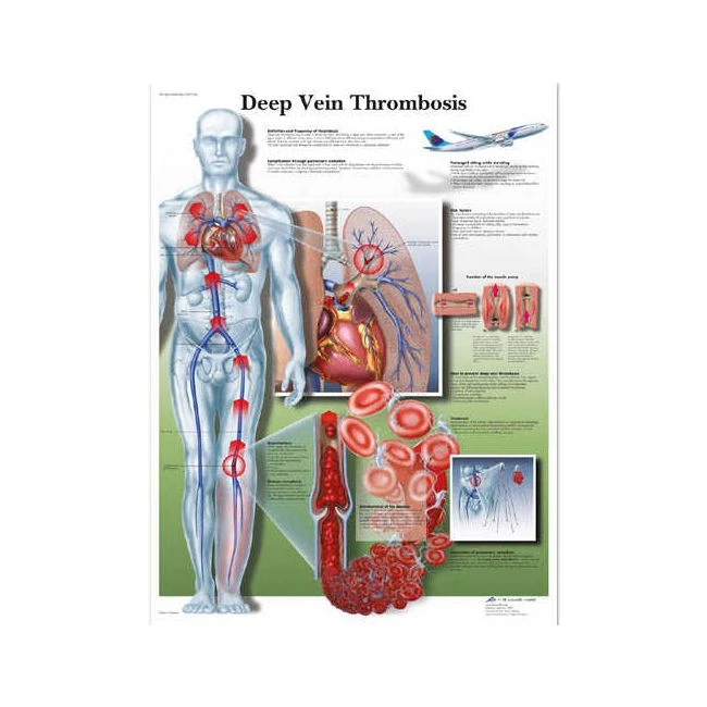 Fabrication Enterprises Inc Z13415 Deep Vein Thrombosis Anatomical ...